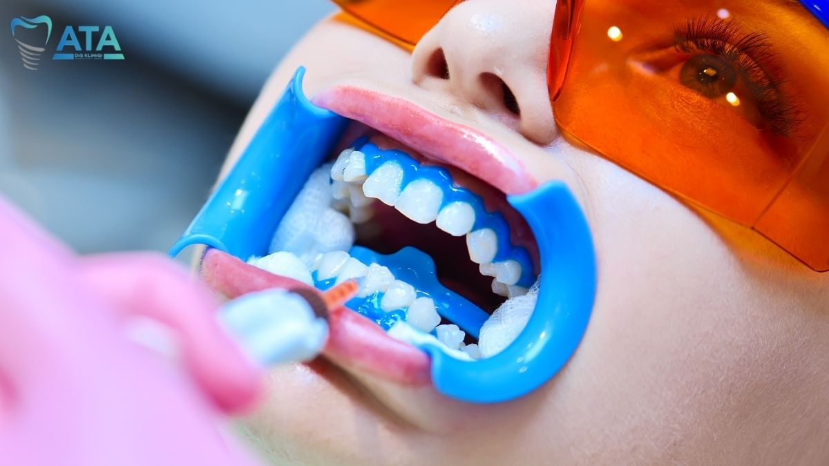 Teeth Whitening and Bleaching in Turkey - Ata Dental Clinic