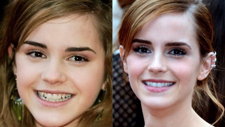 7 Celebrity Veneers Before and After Transformations - Ata Diş Kliniği
