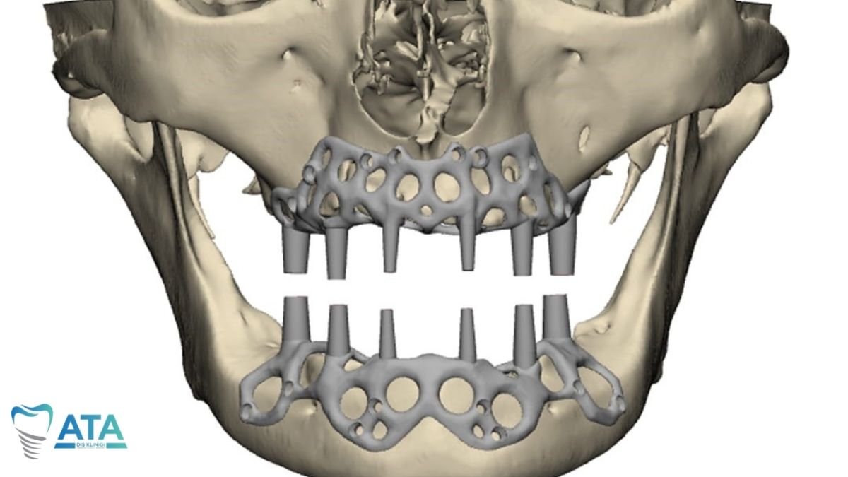 Subperiosteal Implants in Turkey | Ata Dental Center