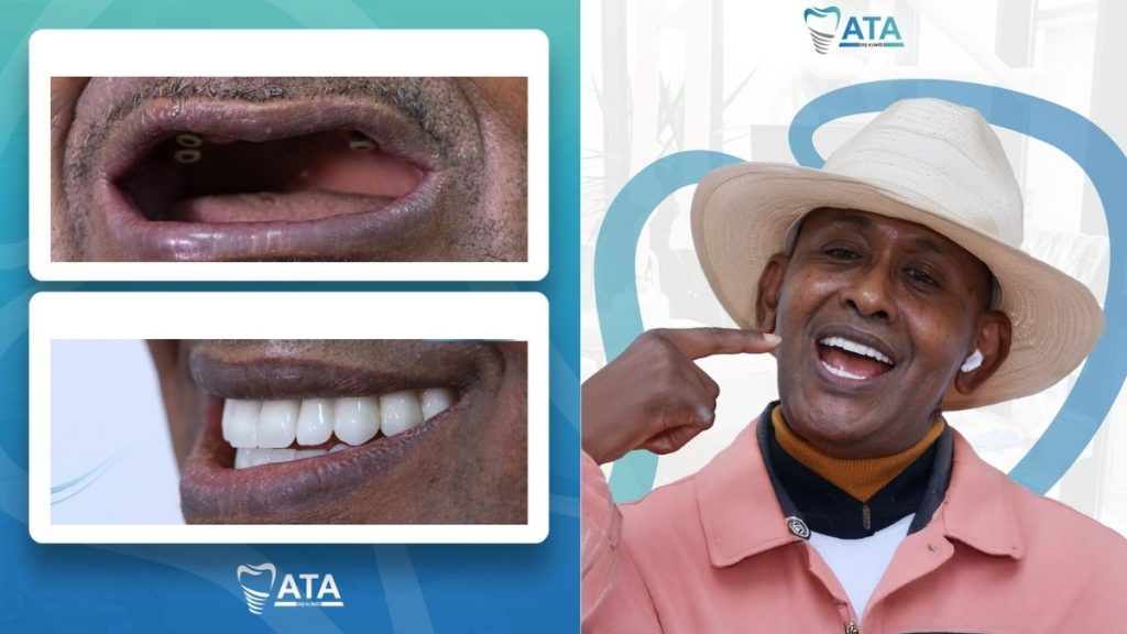 Second Stage Implant Surgery: What to Expect and Recovery Timeline- Ata ...