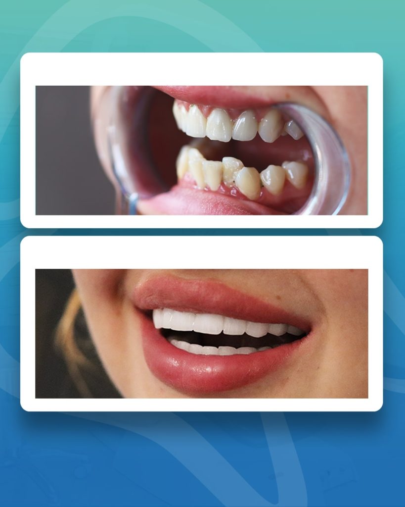 “What Are Turkey Teeth?” (Myth-busting, Safety-first) - Ata Diş Kliniği