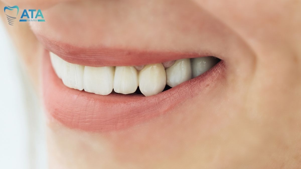 Monolithic Zirconia Crown in Turkey- Cost, Reviews | Ata Dental